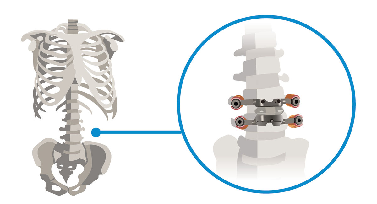 An alternative to spinal fusion for lower back pain | UCI Health ...