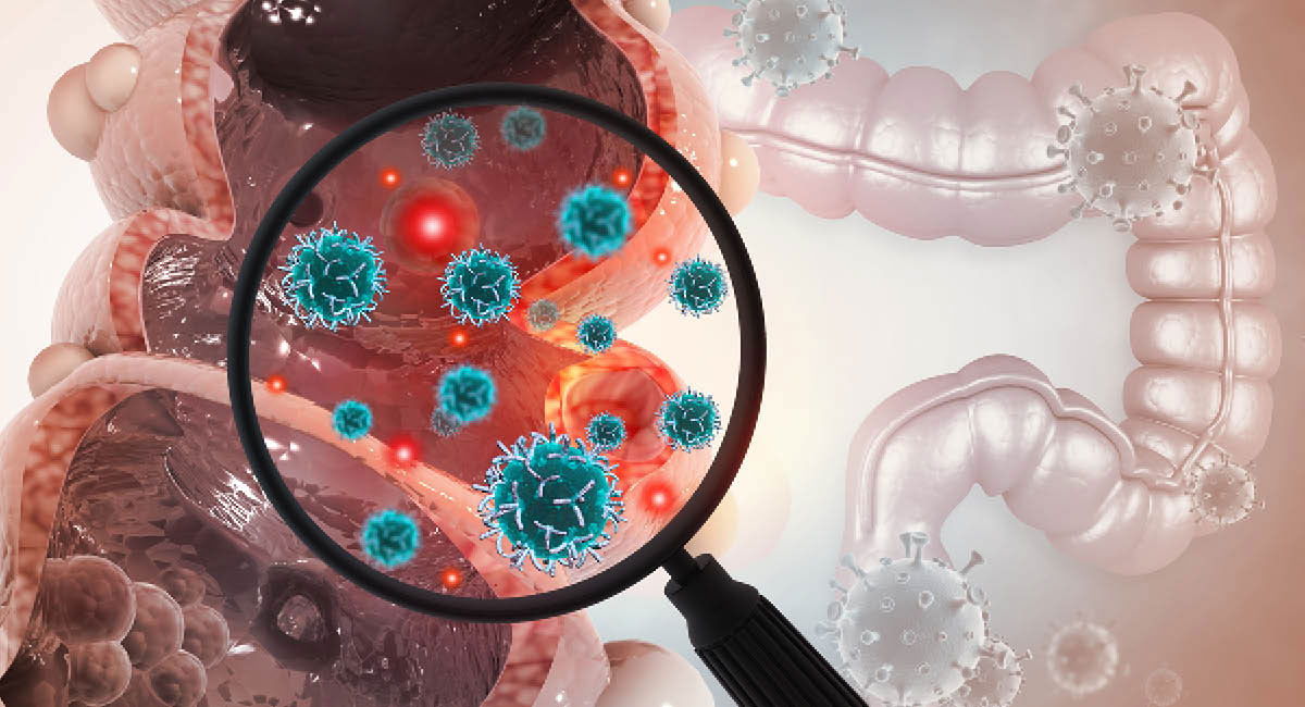 Sounding the alarm on Lynch syndrome | UCI Health | Orange County, CA
